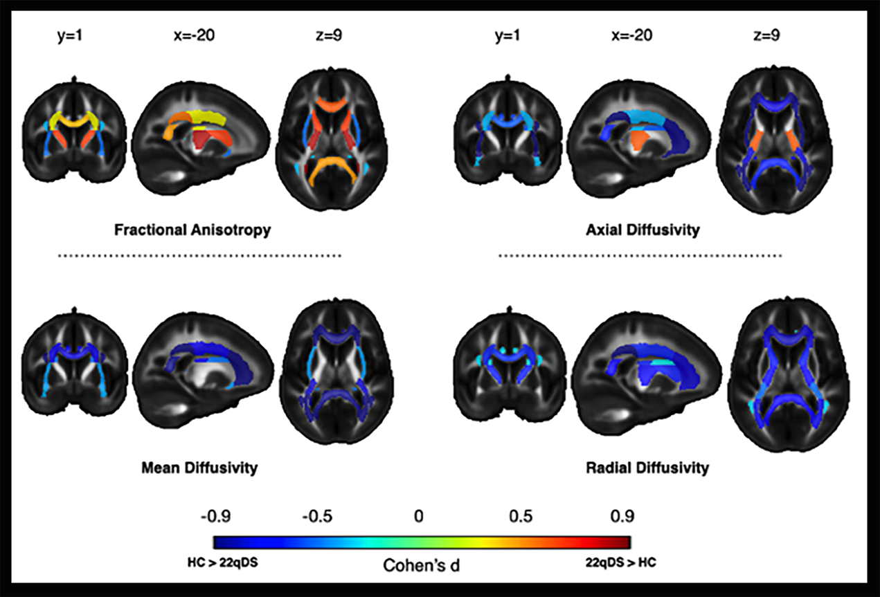 Large scale neuroimaging study seeks to pinpoint brain changes behind ...